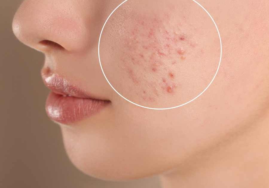 Acne - Regen Clinic